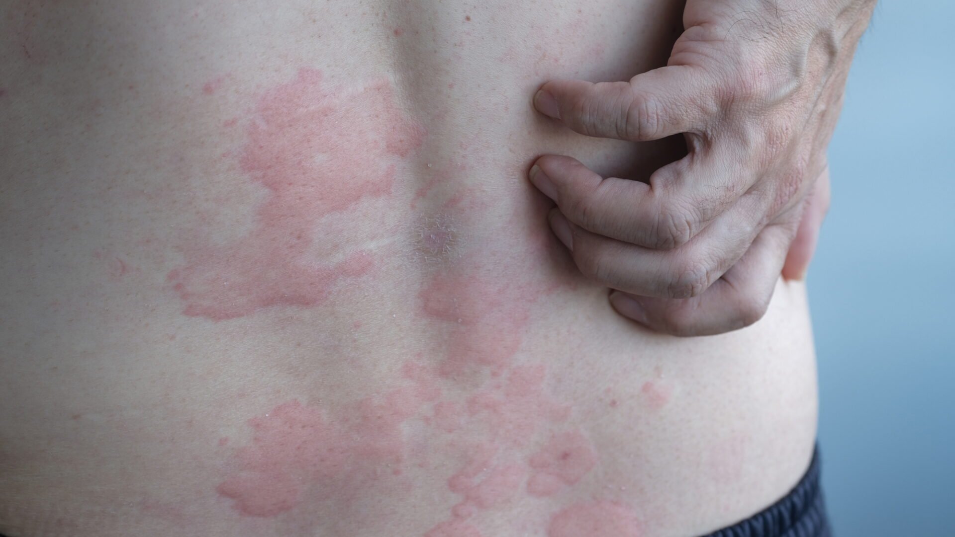 Apteeker: psoriaasi pole võimalik välja ravida, kuid ...